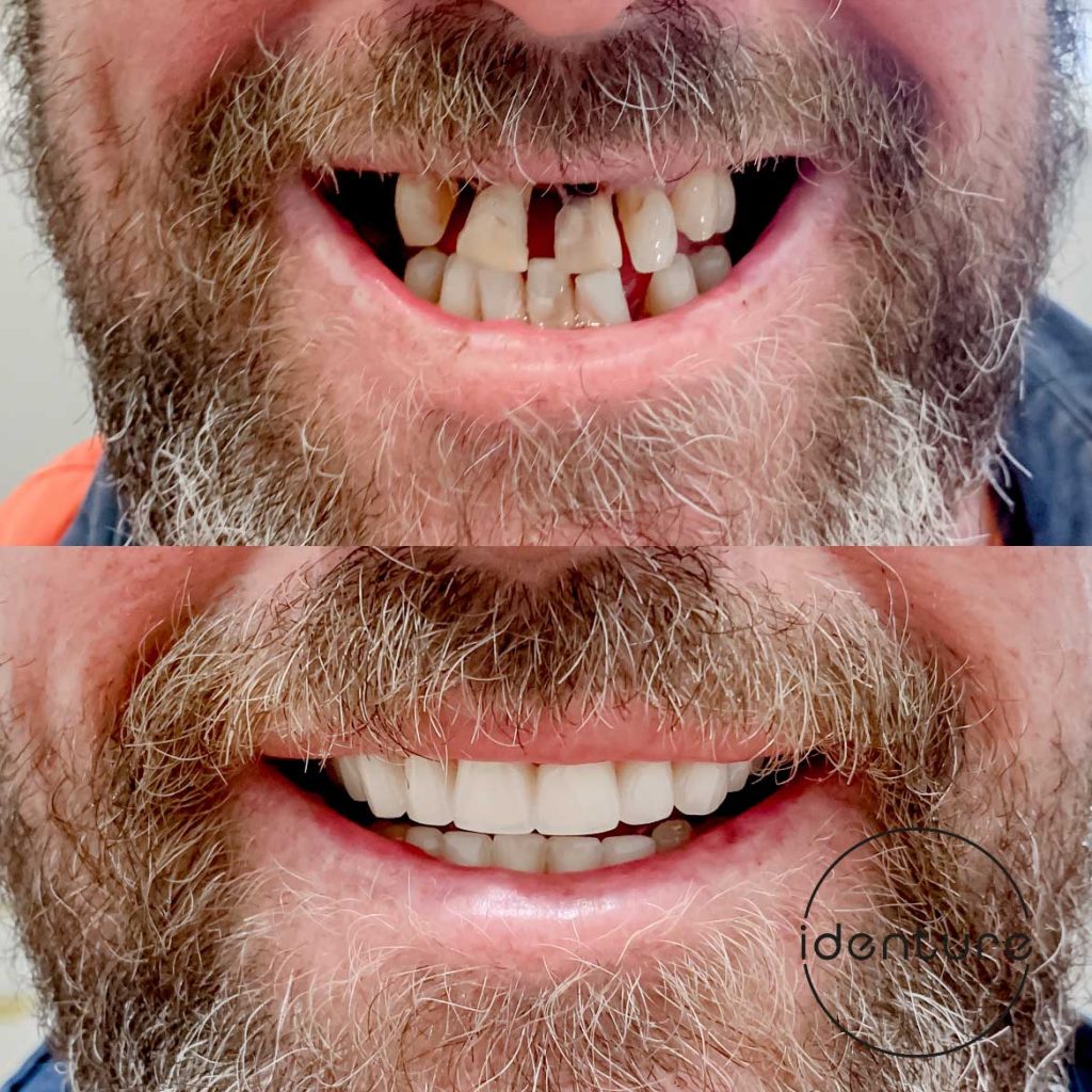 Have A Glance To Your Future Full Dentures